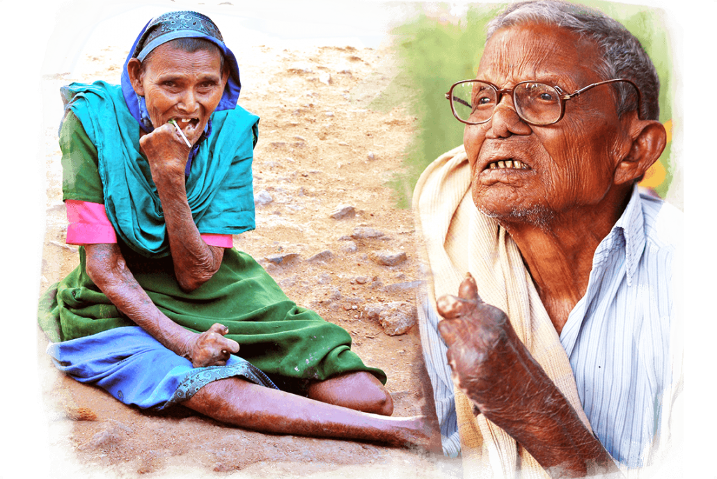 Providing Medical Care for Lepers - India Hope